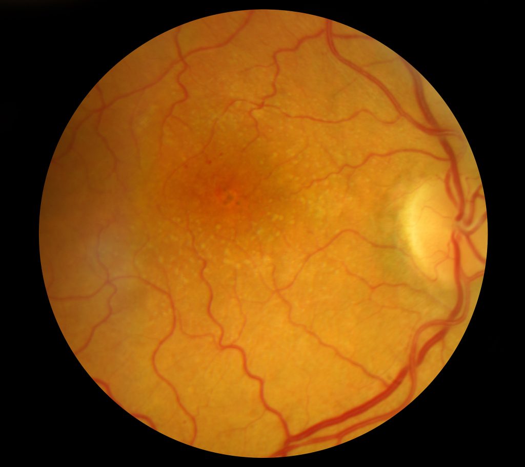 Medical Fundus photo of retinal pathology, hemmorhages, vein occ ...