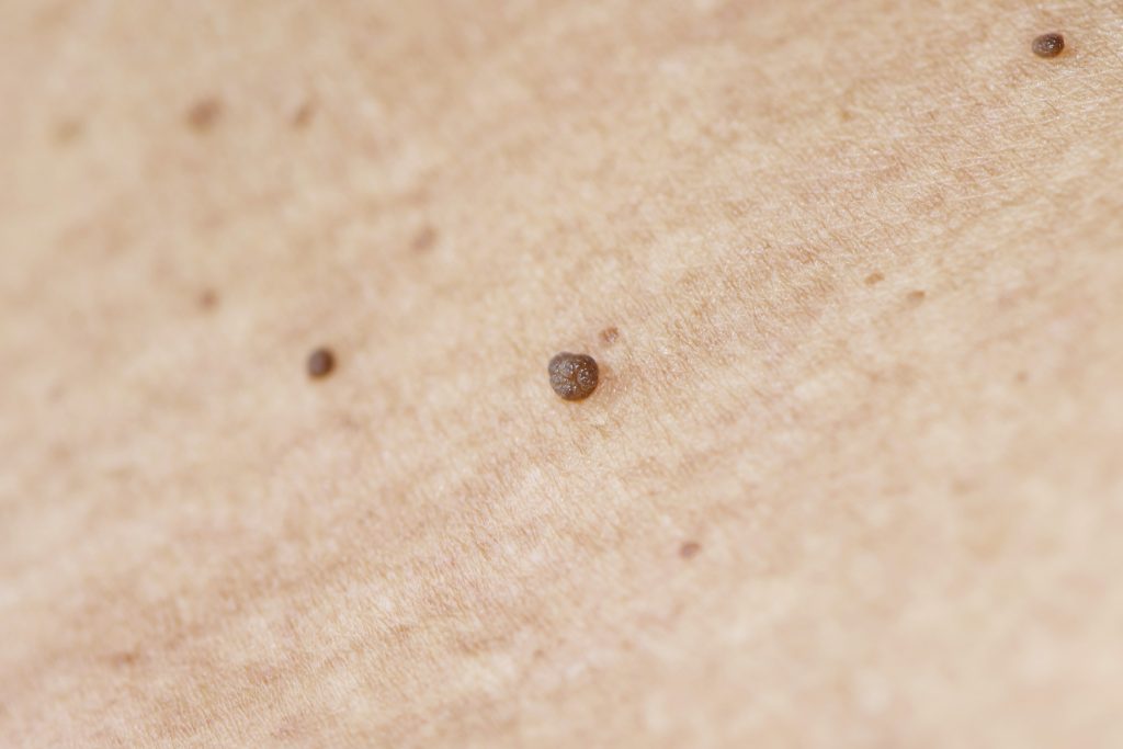 Warts – Skin Tag Disease | Daily Health Alerts
